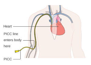 PICC (Peripherally Inserted Central Catheter) 말초 삽입 중심 정맥관 - 의학당