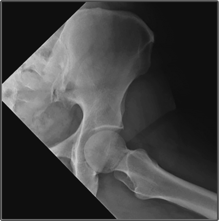 Hip Joint X-ray (Frog leg Lateral View) Anatomy - 의학당