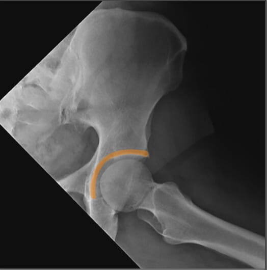 Hip Joint X-ray (Frog leg Lateral View) Anatomy - 의학당