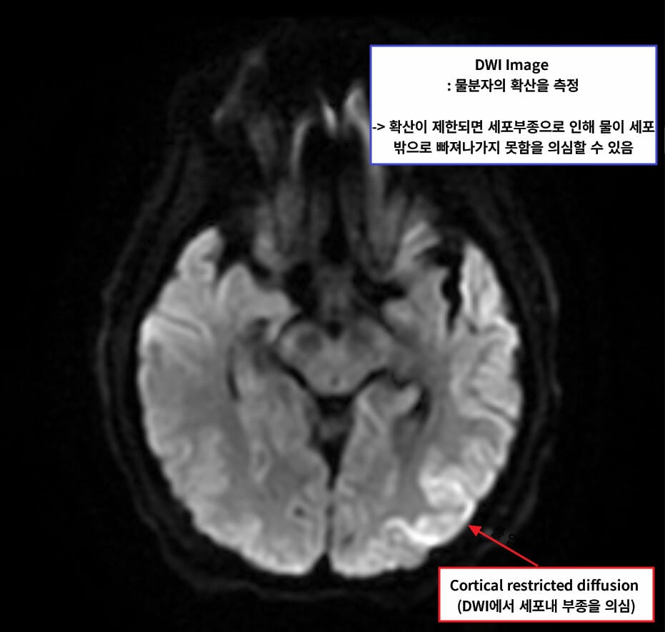 크로이츠펠트-야콥병 (Creutzfeldt-Jakob disease, CJD) - 의학당