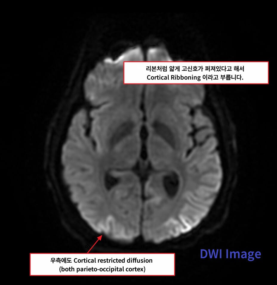 크로이츠펠트-야콥병 (Creutzfeldt-Jakob disease, CJD) - 의학당