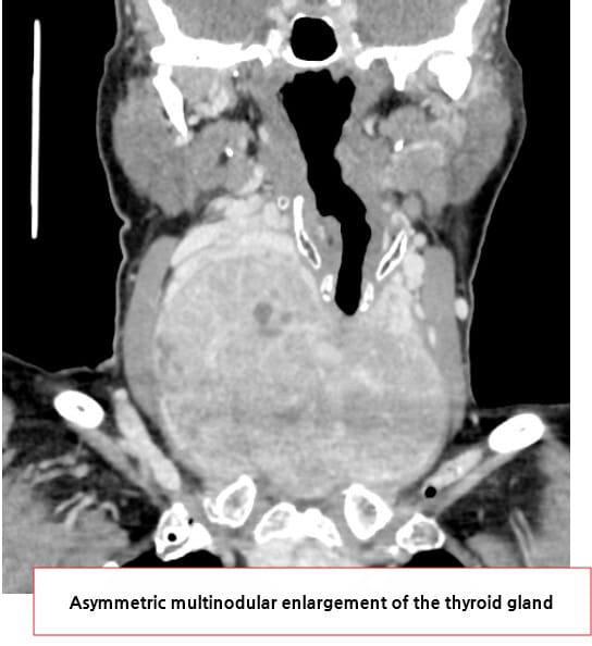 독성 결절성 갑상선종 (Toxic Nodular Goiter) - 의학당