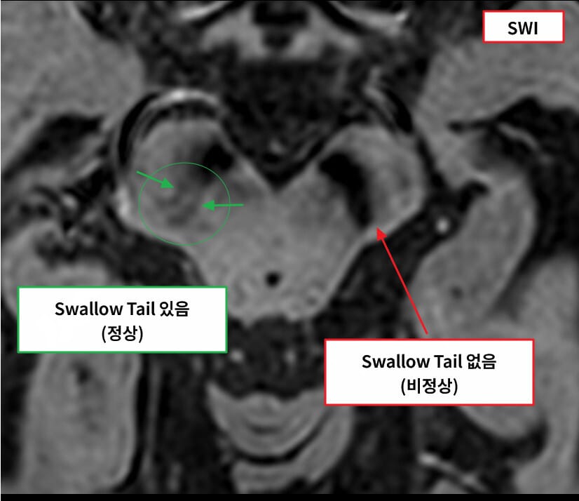 파킨슨병 (Parkinson's Disease) - 의학당