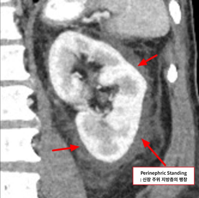 신우신염 (Pyelonephritis) - 의학당