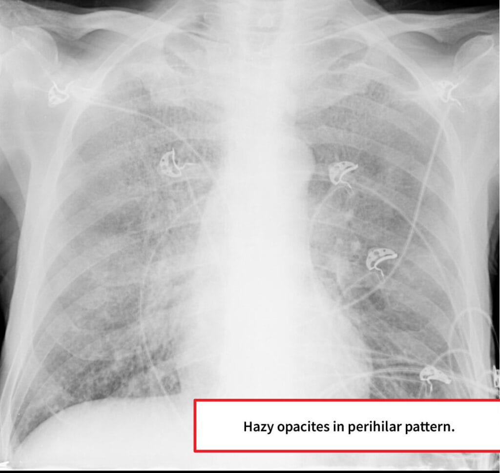 폐포자충 폐렴 (Pneumocystis pneumonia, PCP) - 의학당