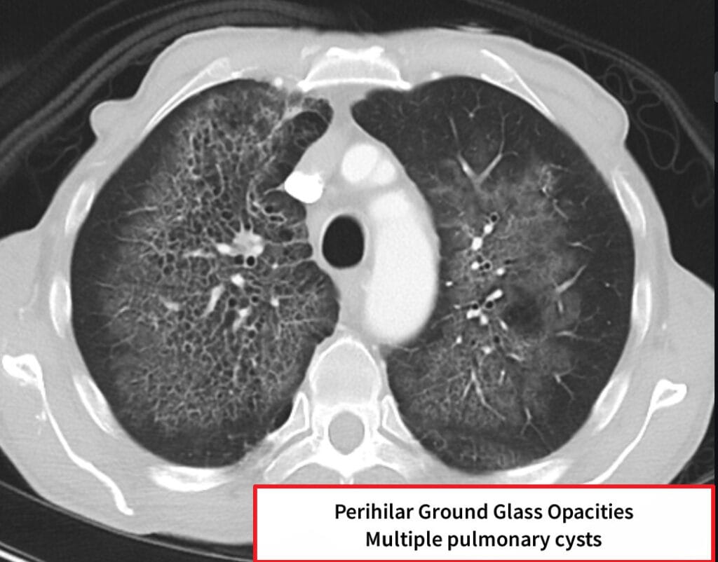 폐포자충 폐렴 (Pneumocystis pneumonia, PCP) - 의학당