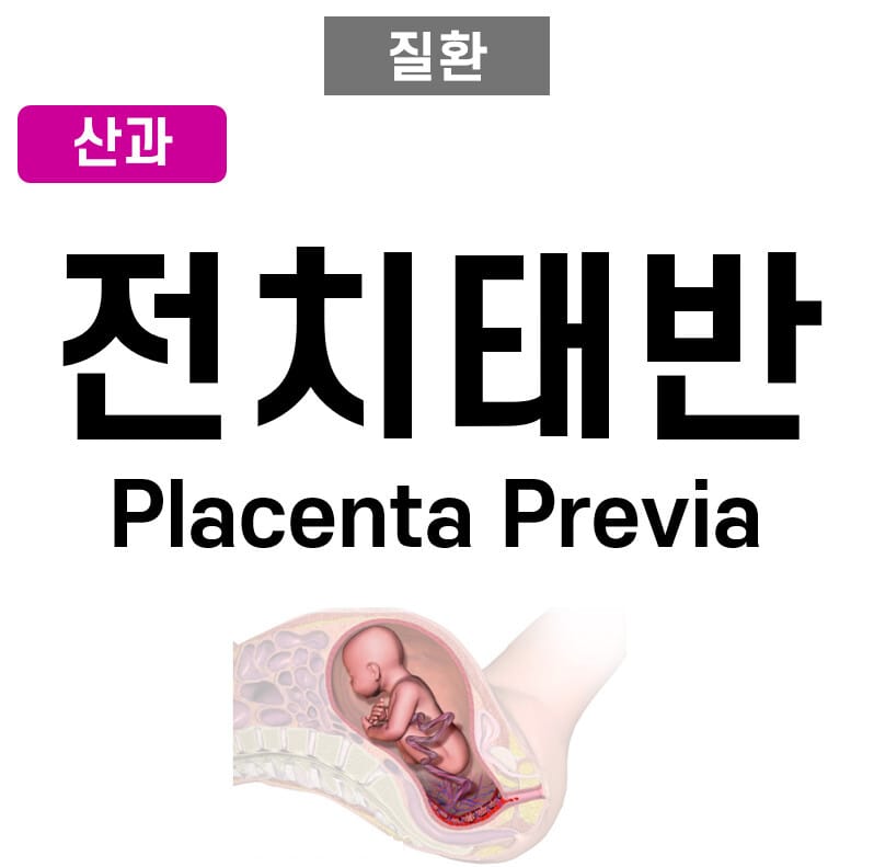 전치태반 (Placenta Previa) - 의학당