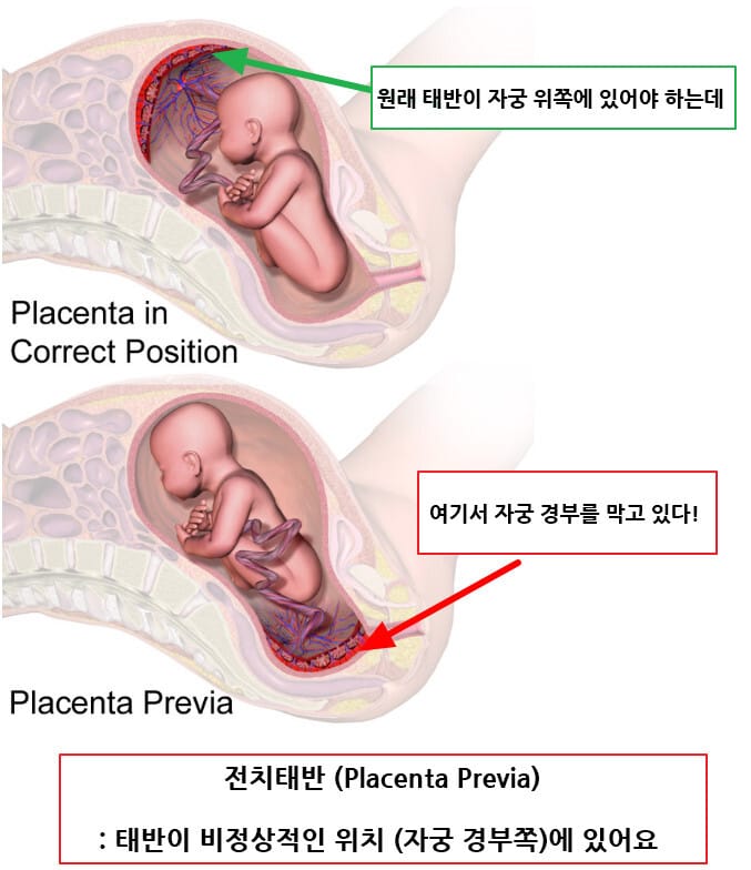 전치태반 (Placenta Previa) - 의학당